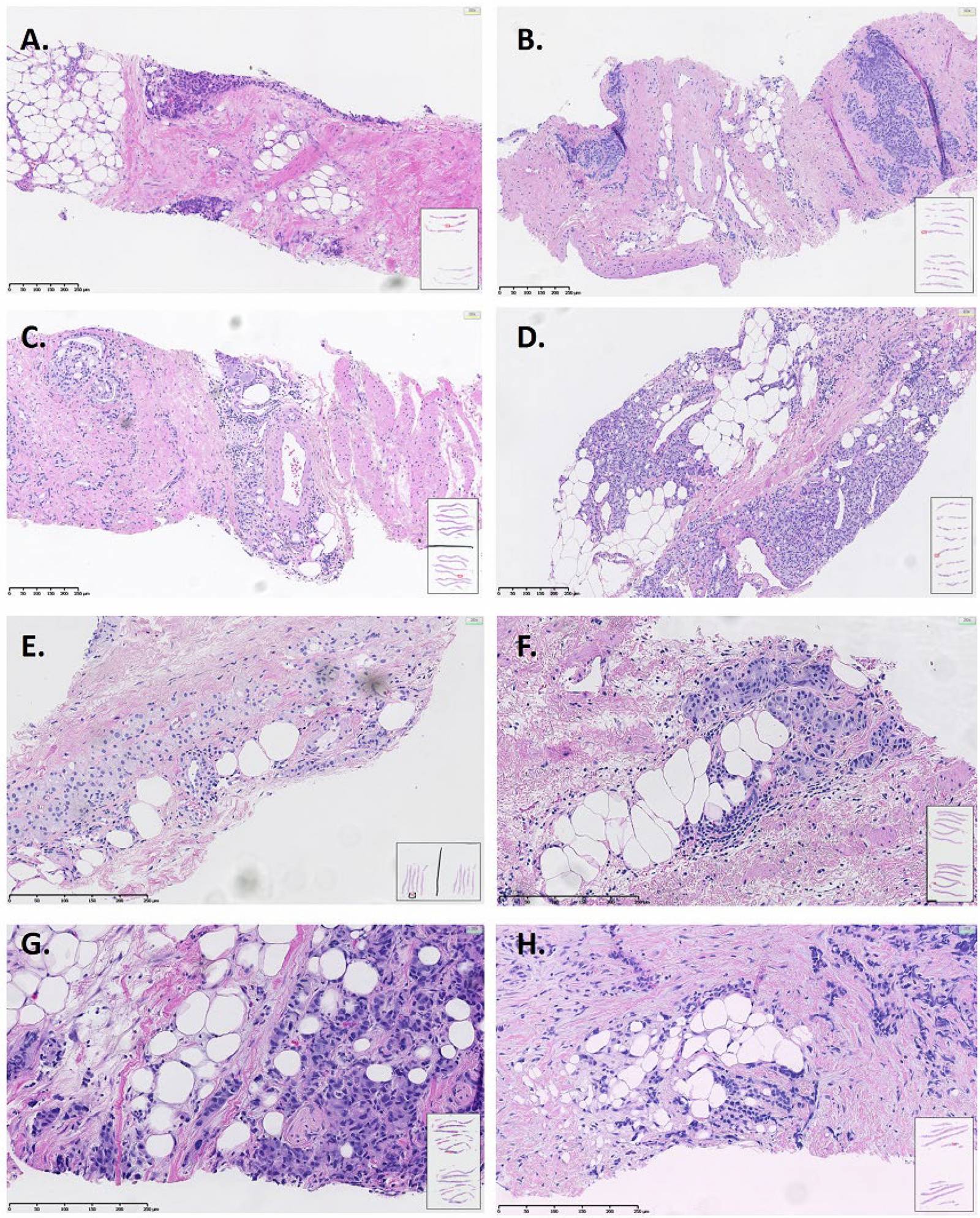 Highlighted Publications | Prostate Cancer Research Center | Tampere ...