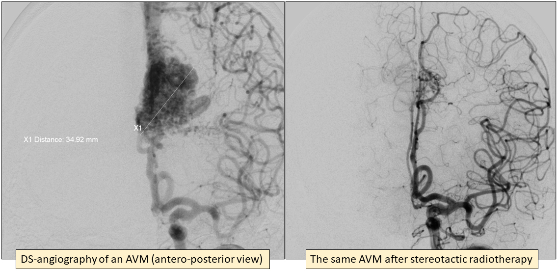 Arteriovenous malformations of the brain | Hemorrhagic Brain Pathology ...